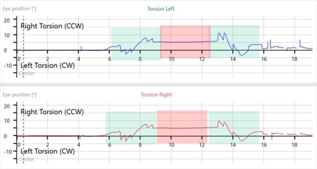 Ocular Counter-Roll Test | Akdeniz Vertigo Merkezi