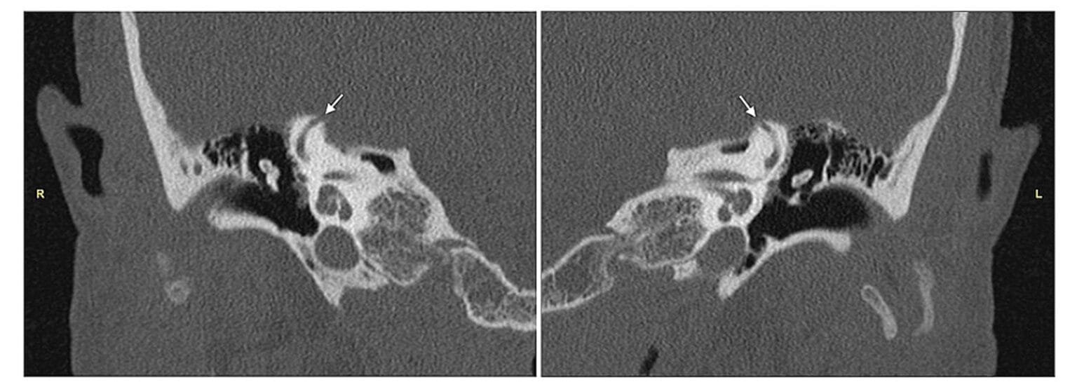 Superior Semisirküler Kanal Dehissansı (SSCD) | Akdeniz Vertigo Merkezi